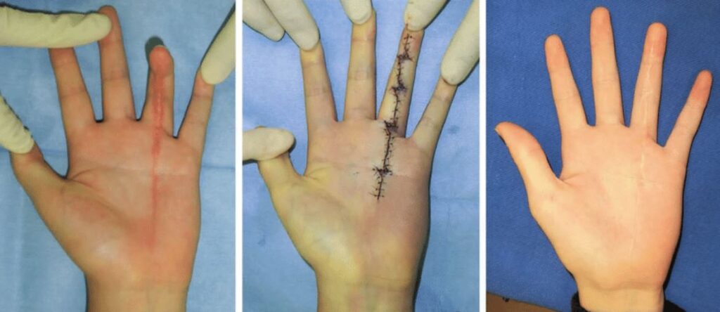 Post Traumatic Contracture – Hand and Nerve Surgeon
