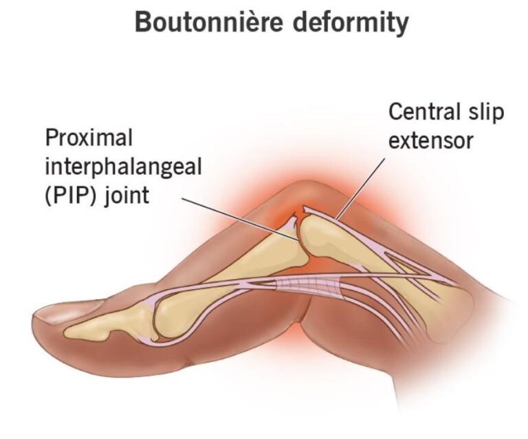 Boutonniere Deformity – Hand and Nerve Surgeon