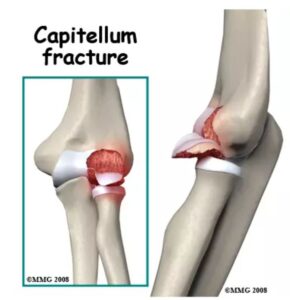 Capitellar fracture – Hand and Nerve Surgeon