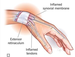 Extensor Tenosynovitis – Hand and Nerve Surgeon
