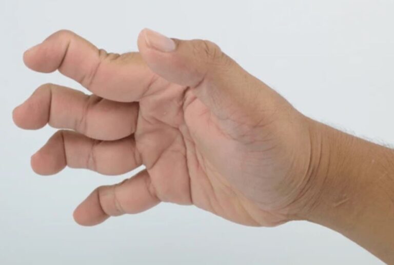 Swan Neck Deformity – Hand and Nerve Surgeon