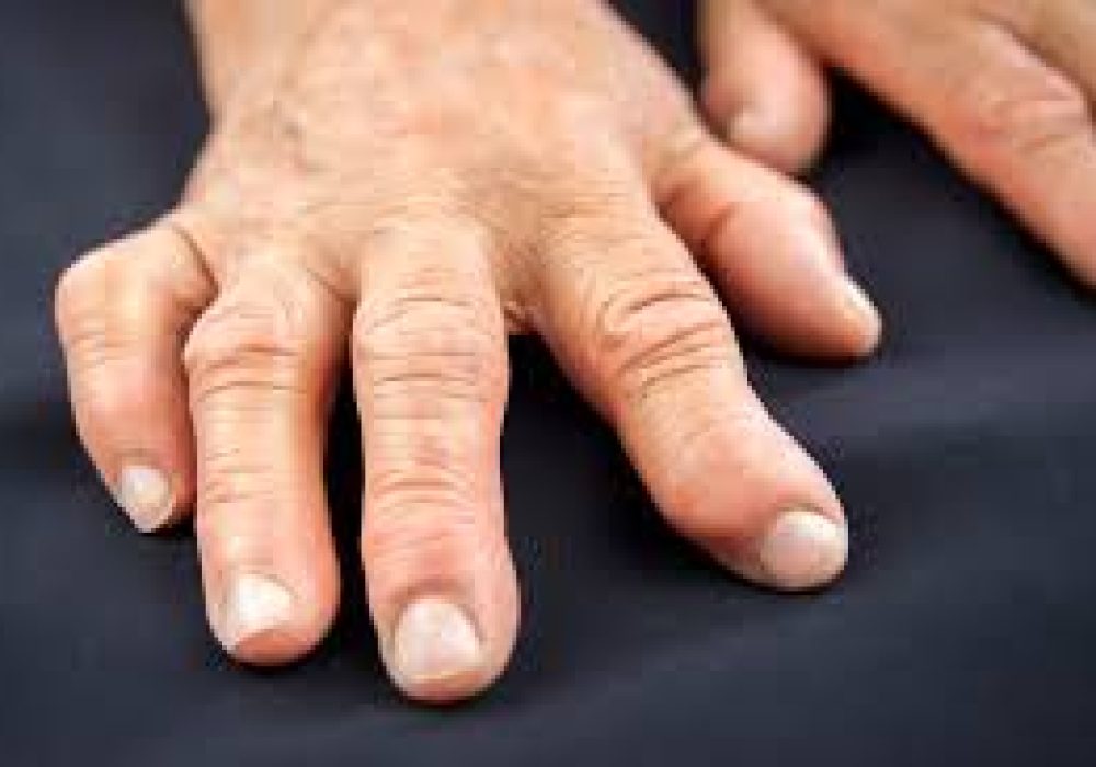 Joint Deformities – Hand and Nerve Surgeon